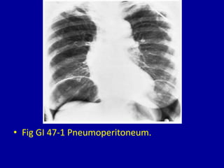 47 extraluminal gas in the upper quadrants | PPTX