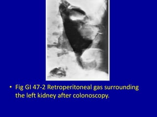 47 extraluminal gas in the upper quadrants | PPTX