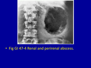 47 extraluminal gas in the upper quadrants | PPTX