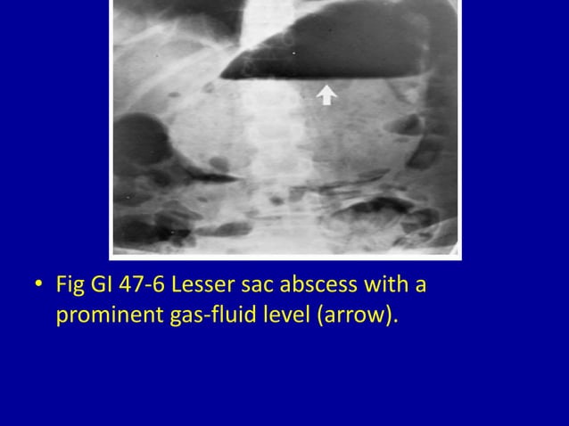 47 extraluminal gas in the upper quadrants | PPTX