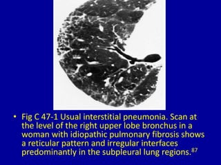 47 interstitial lung disease on computed tomography | PPTX