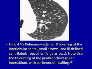 47 interstitial lung disease on computed tomography | PPTX