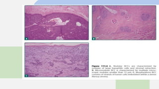 KARSINOMA SEL BASAL MERUPAKAN NEOPLASMA YANG BERASAL DARI SEL TANPA ...