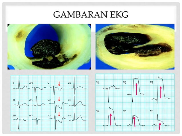 480628355-2-PPT-LAPSUS-1-SKA-NSTEMI.pptx