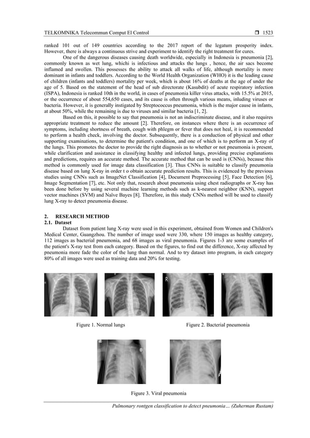Pulmonary rontgen classification to detect pneumonia disease using convolutional neural networks ...