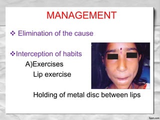 oral habits and mouth breathing | PPTX