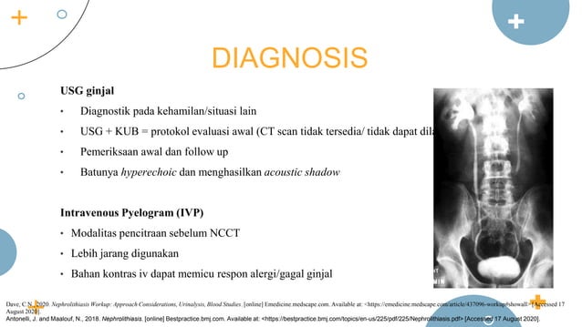 485349147-Nefrolitiasis-BST-dr-Bungaran-pptx.pptx
