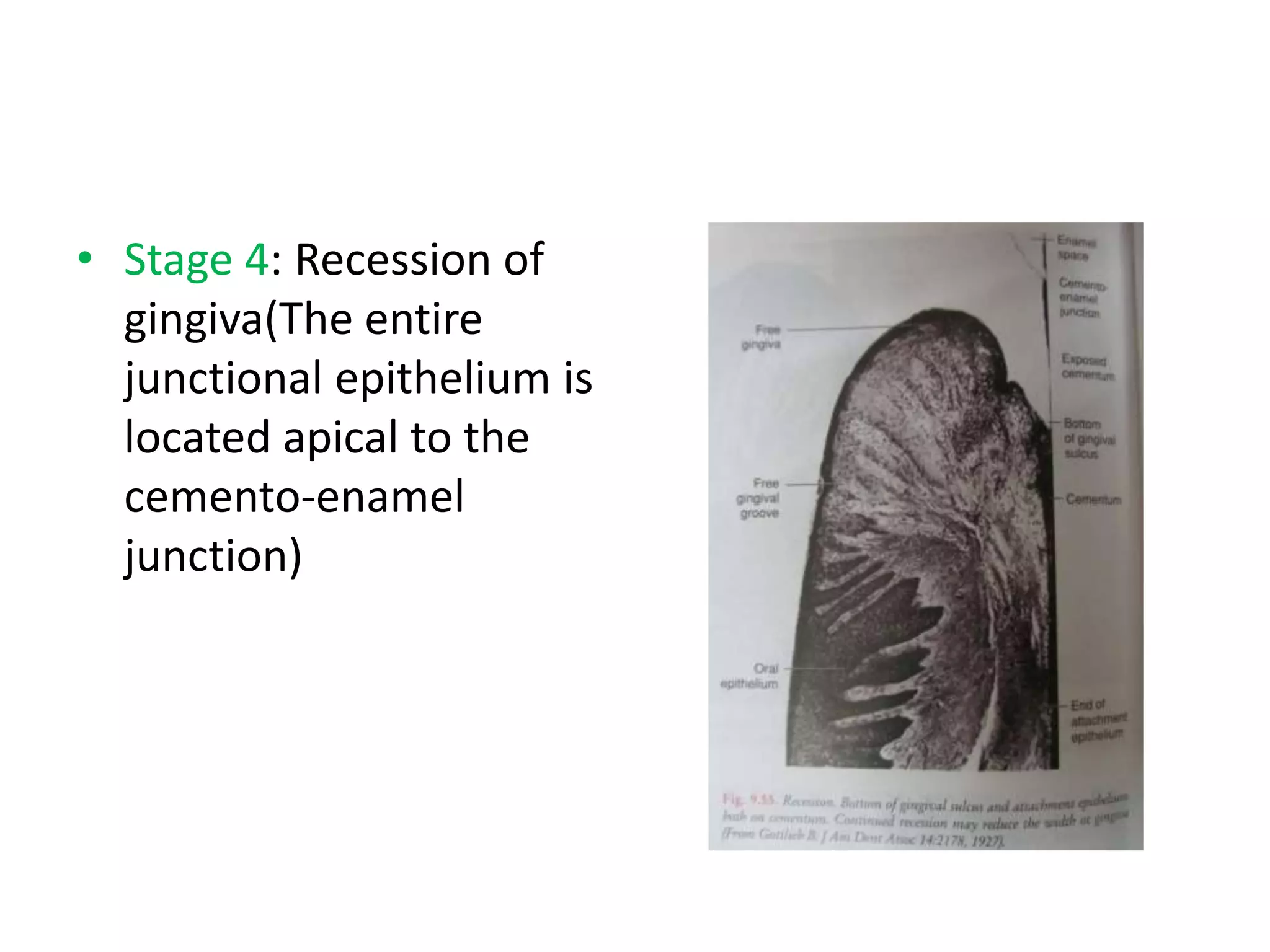 486 junctional epithelium | PPTX