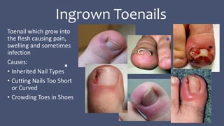 Happy Healthy Feet | PPTX