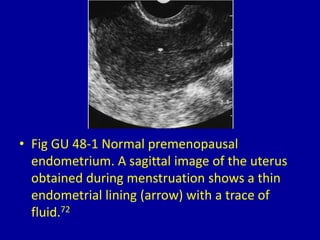 48 the endometrium | PPTX