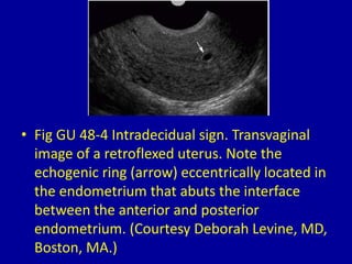 48 the endometrium | PPTX