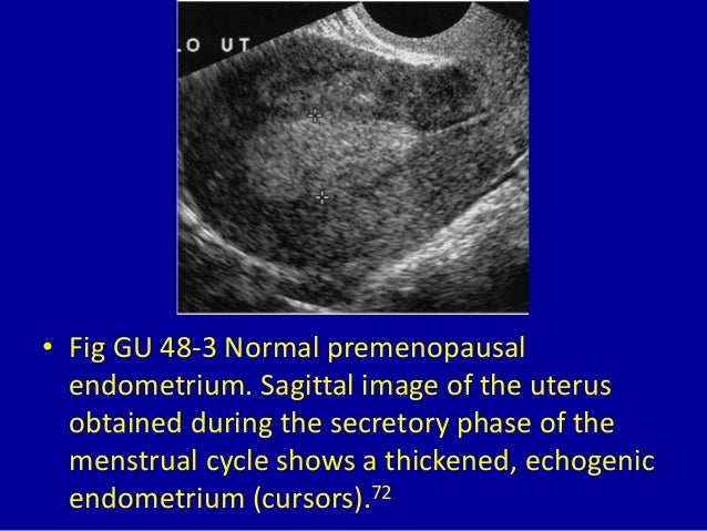 Endometrial Lining Thickness After Menopause