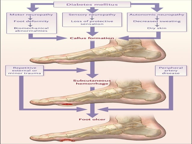 490464824-6-DIABETIC-FOOT-ppt.ppt.... pt.ppt. | PPT