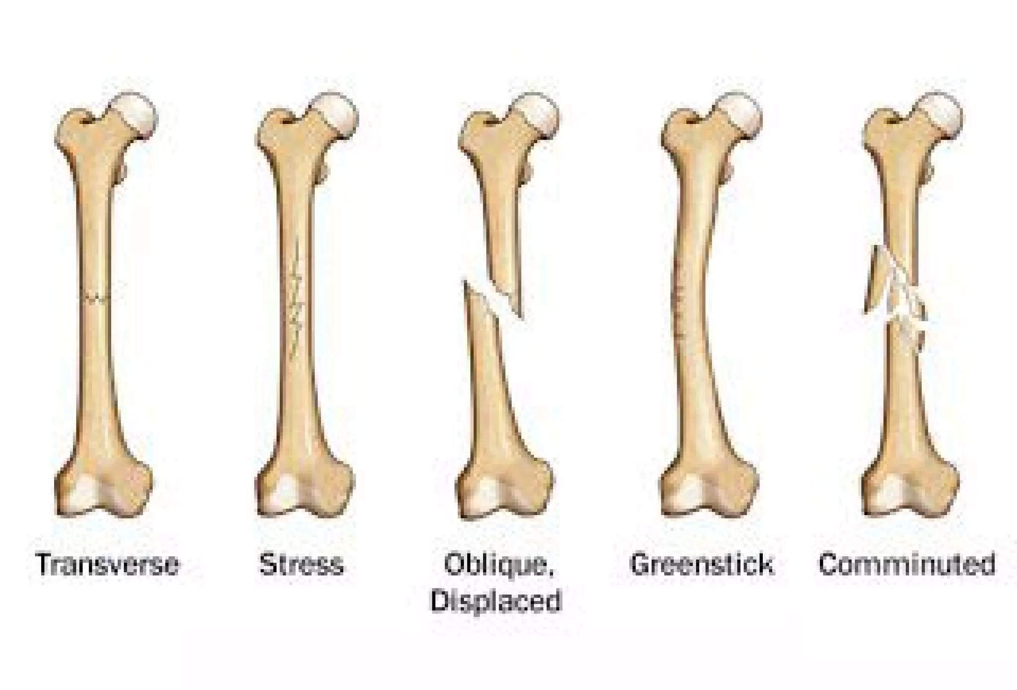 The different types of bone fracture | PPT