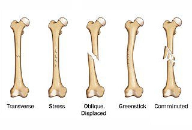 The different types of bone fracture | PPT