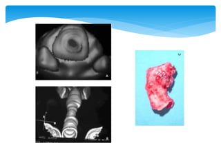 Laryngeal edema and stenosis refer to swelling (edema) and narrowing ...