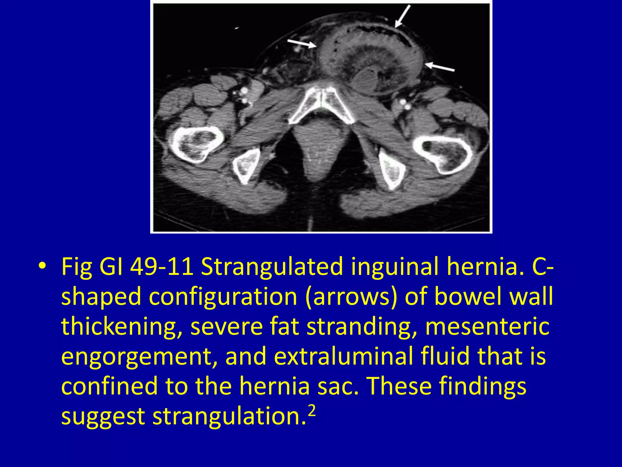 49 abdominal hernias | PPTX