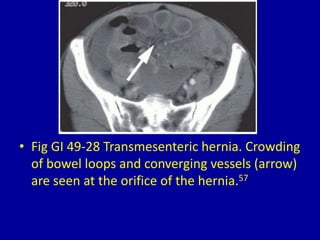 49 abdominal hernias | PPTX