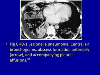 49 alveolar lung disease on computed tomography | PPTX