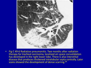 49 alveolar lung disease on computed tomography | PPT