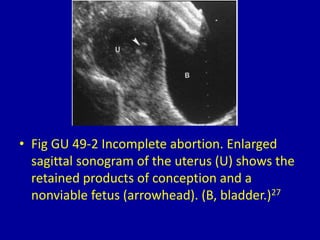 49 complications of pregnancy | PPTX