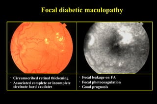 49 diabetic retinopathy | PPT