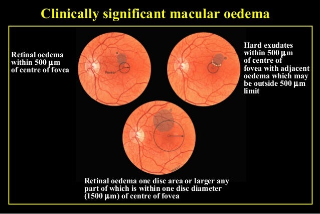 49 diabetic retinopathy
