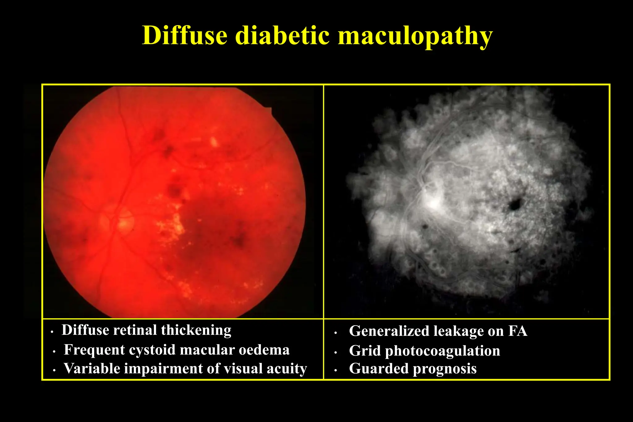 Diabetic Retinopathy.ppt