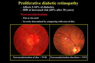 Diabetic Retinopathy.ppt