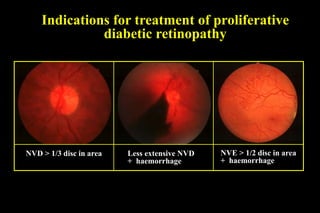 Diabetic Retinopathy.ppt