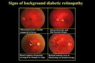 Diabetic Retinopathy.ppt