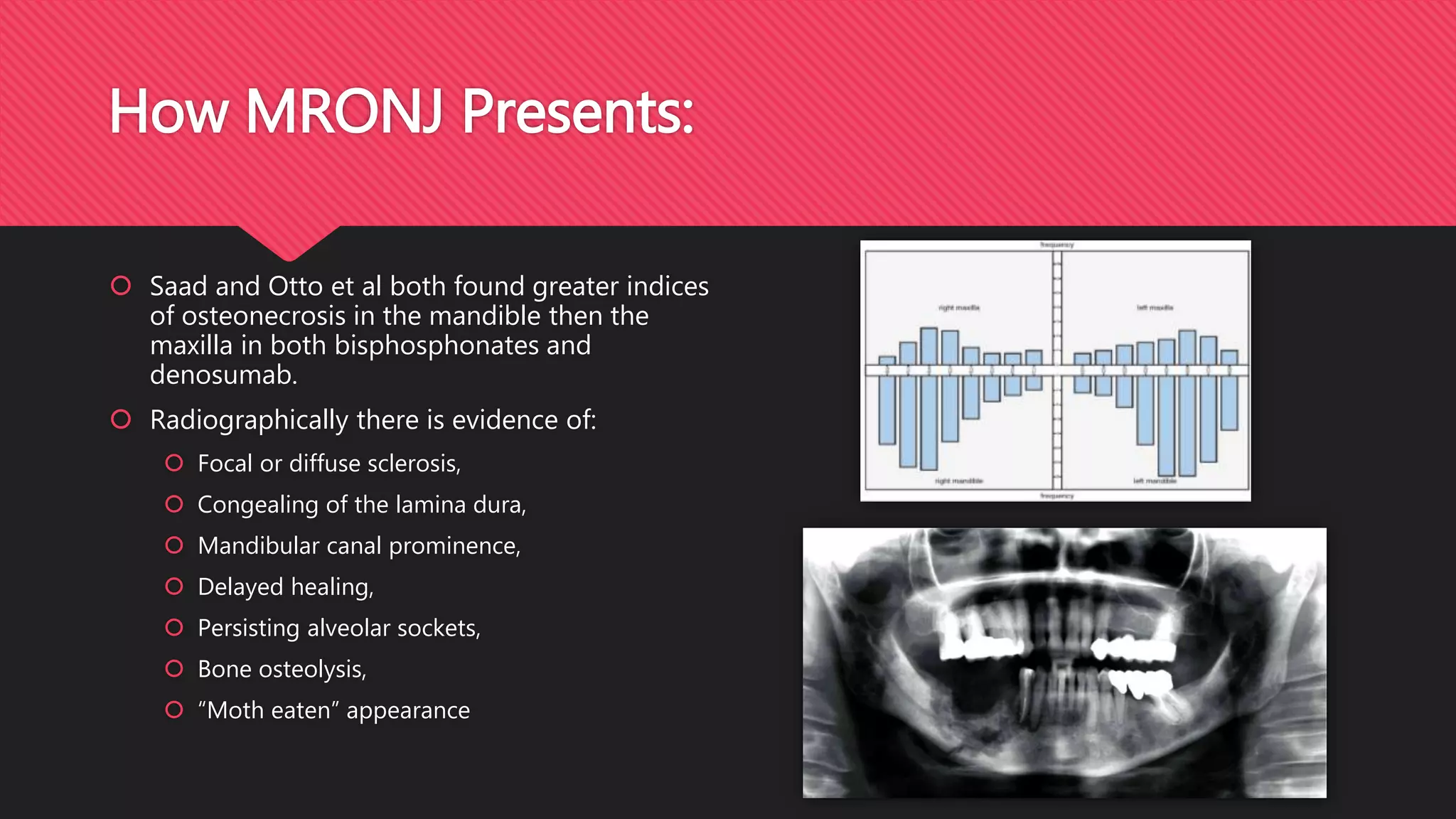 MRONJ PRESENTATION | PPTX