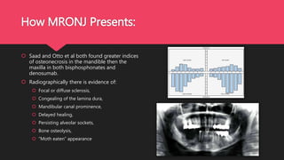 MRONJ PRESENTATION | PPTX
