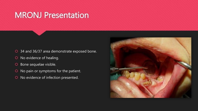 MRONJ PRESENTATION | PPT | Free Download