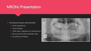 MRONJ PRESENTATION | PPTX