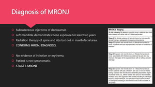 MRONJ PRESENTATION | PPTX
