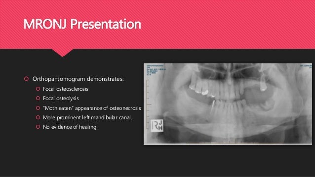 MRONJ PRESENTATION