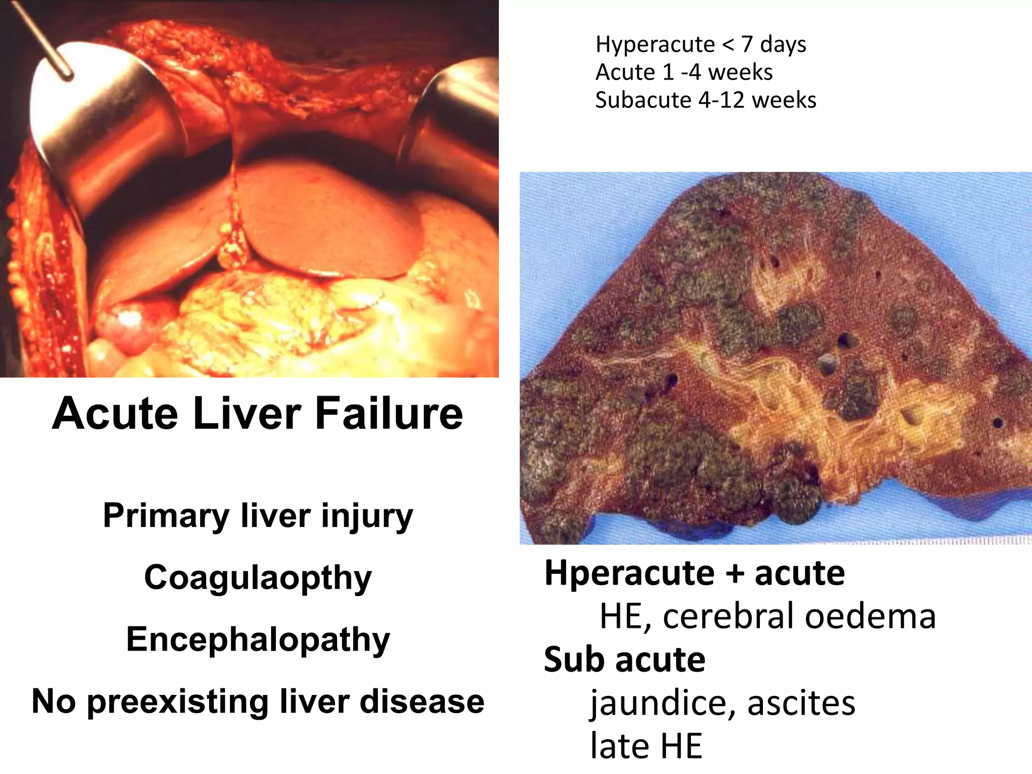 Liver disease in ICU – when to stop? by Julia Wendon | PPTX