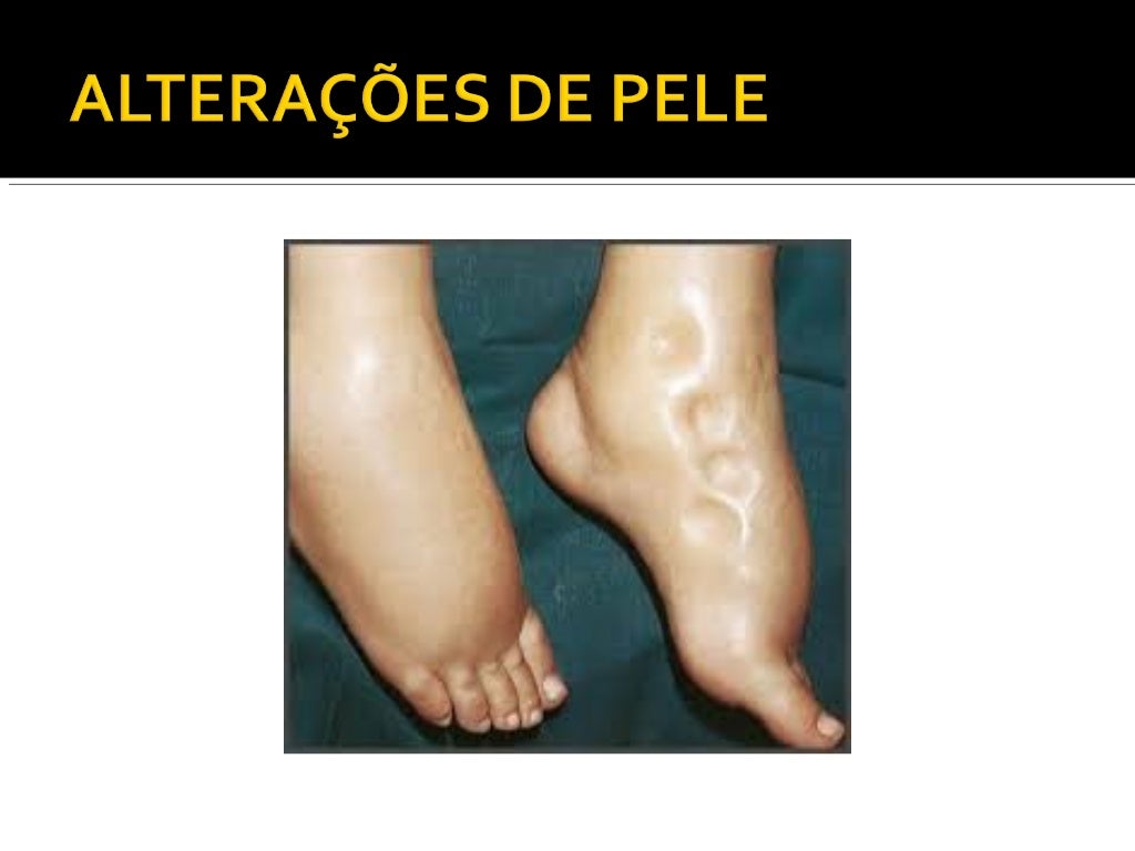 Semiologia dos Edemas