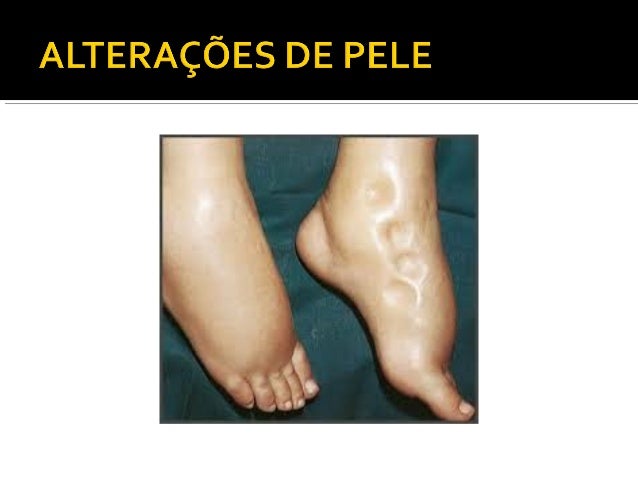 Semiologia dos Edemas