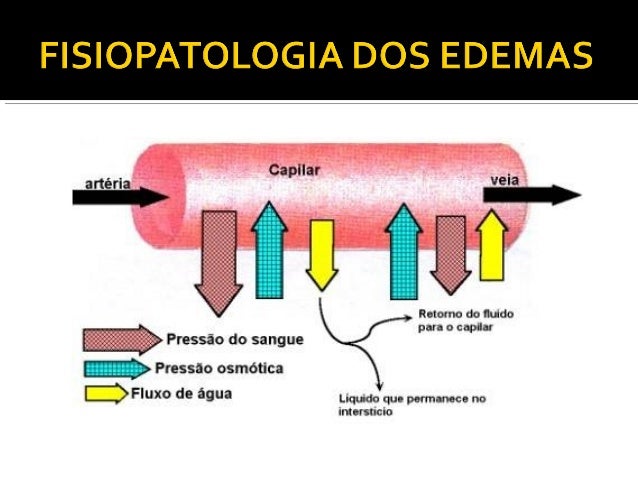 Semiologia dos Edemas