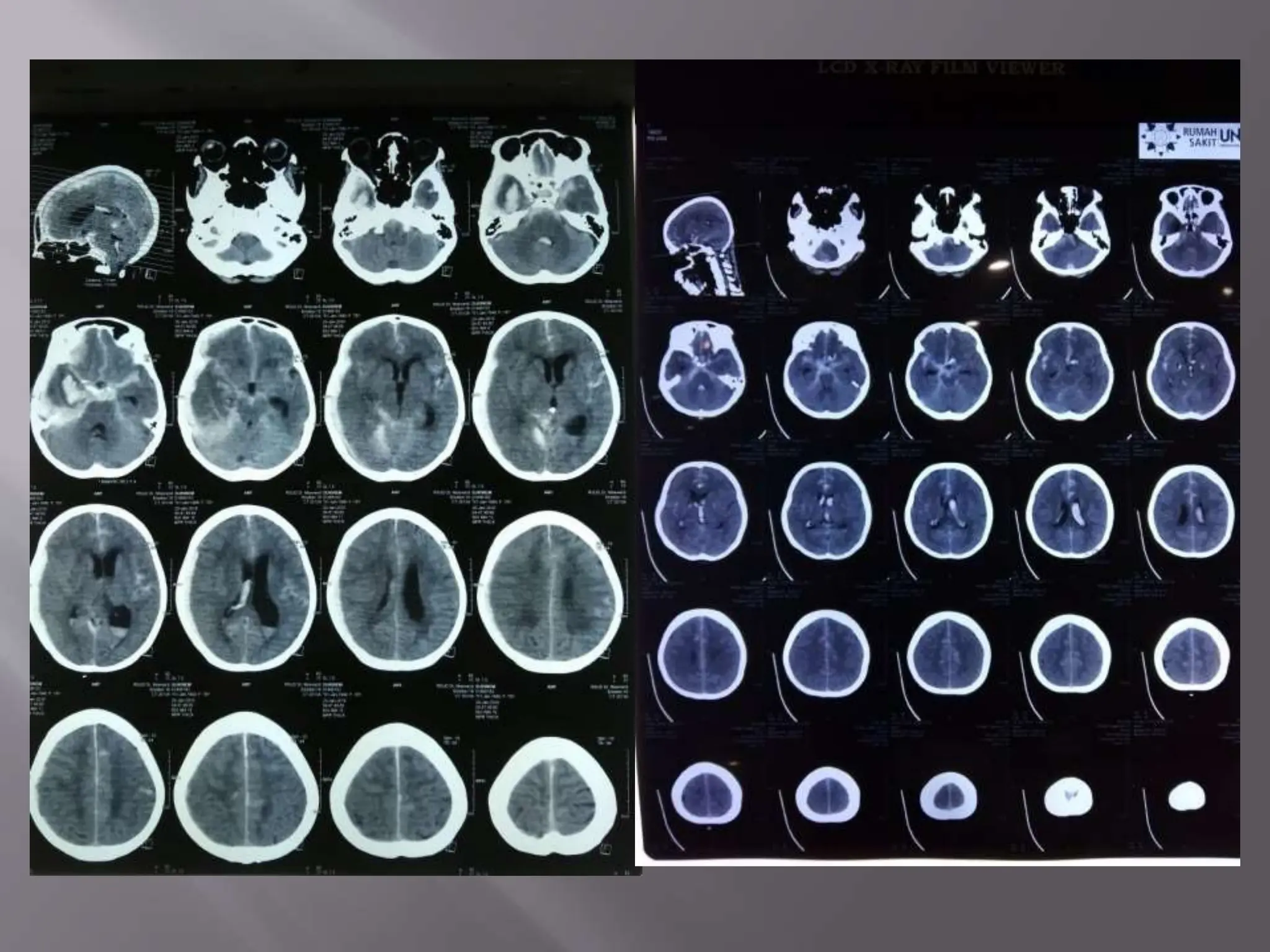4a. Bimbingan Neuroimaging CT Scan Kepala - Residen.pptx