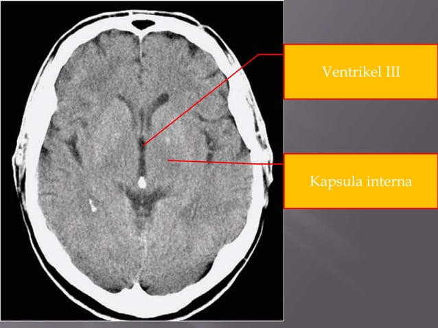 4a. Bimbingan Neuroimaging CT Scan Kepala - Residen.pptx