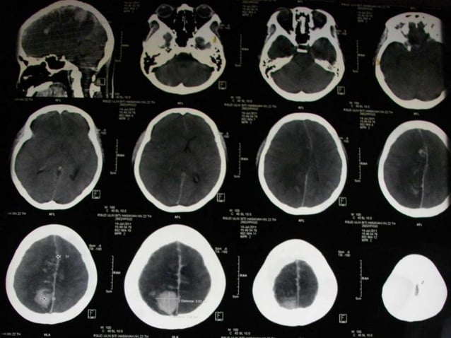 4a. Bimbingan Neuroimaging CT Scan Kepala - Residen.pptx