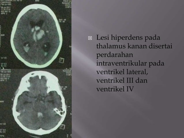 4a. Bimbingan Neuroimaging CT Scan Kepala - Residen.pptx