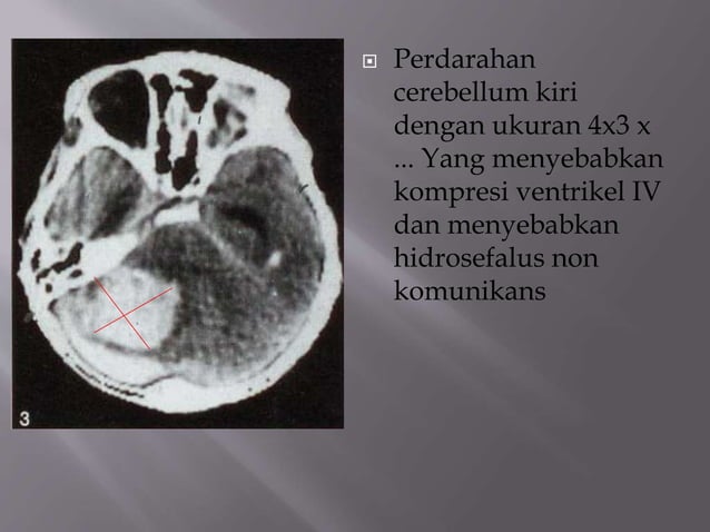 4a. Bimbingan Neuroimaging CT Scan Kepala - Residen.pptx