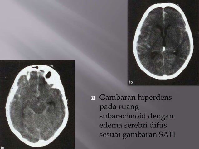 4a. Bimbingan Neuroimaging CT Scan Kepala - Residen.pptx
