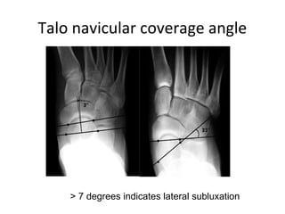 4 a adult acquired flat foot - Derek Park | PPT