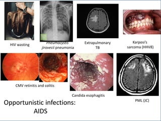 Importance and implication of starting HIV treatment early | PDF