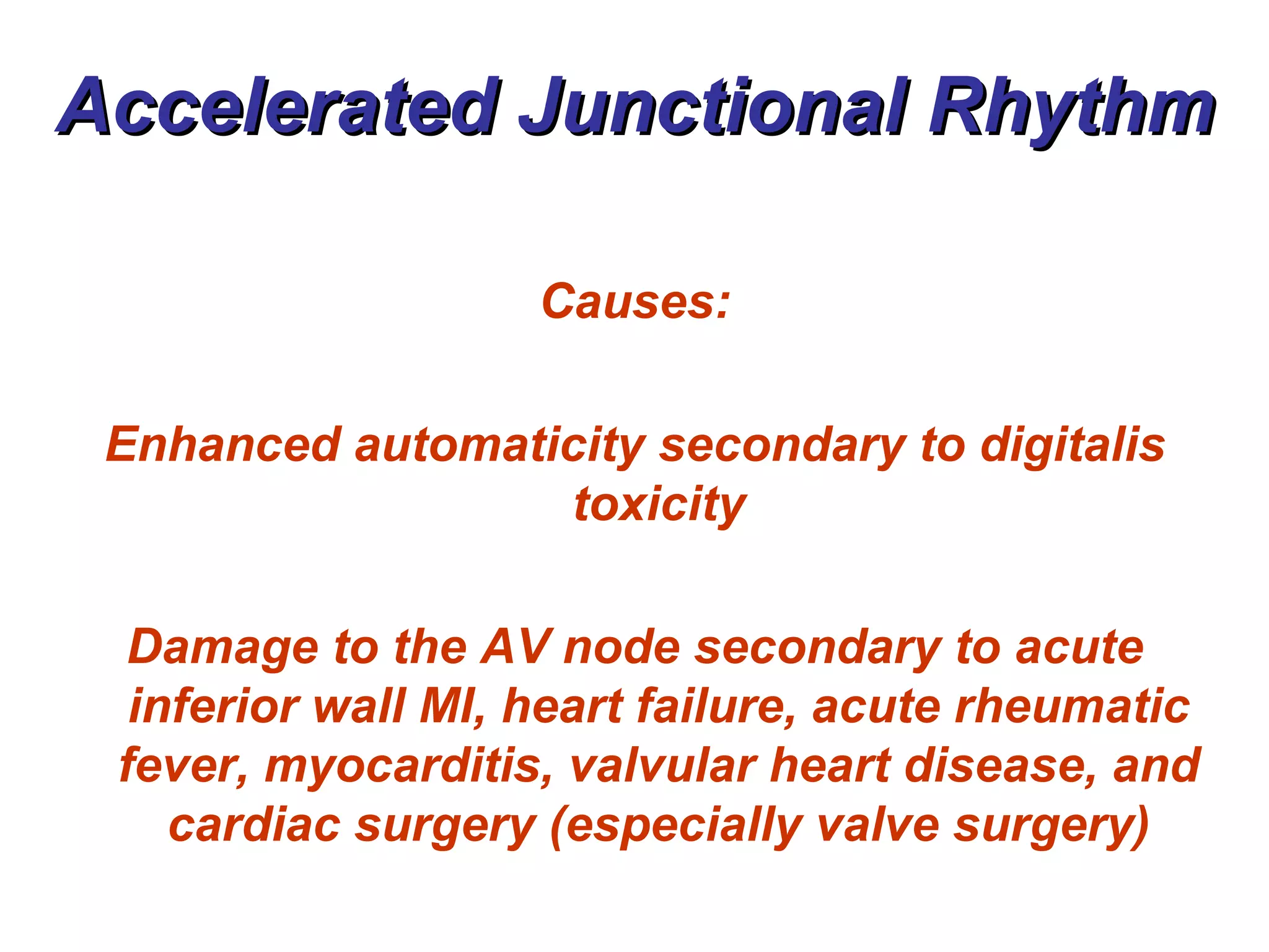 Junctional Rhythms - BMH/Tele | PPT